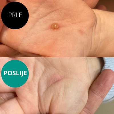 BIOVITALIS MEDNA ROSA PLUS TEKUĆINA ZA UKLANJANJE BRADAVICA NA KOŽI ...